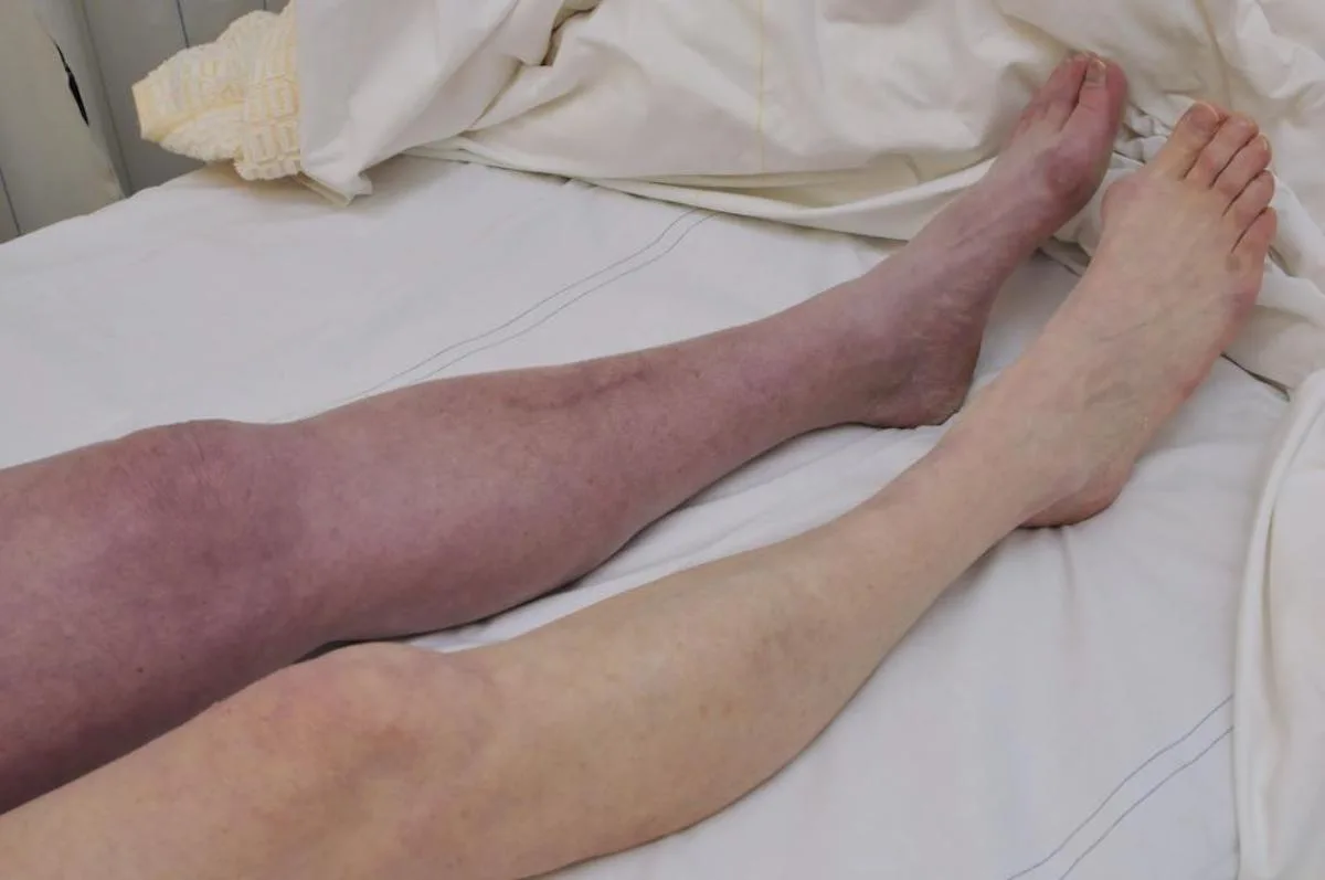 Schwellung oder Schmerzen in Ihrem Bein? Diese Symptome können auf eine ...